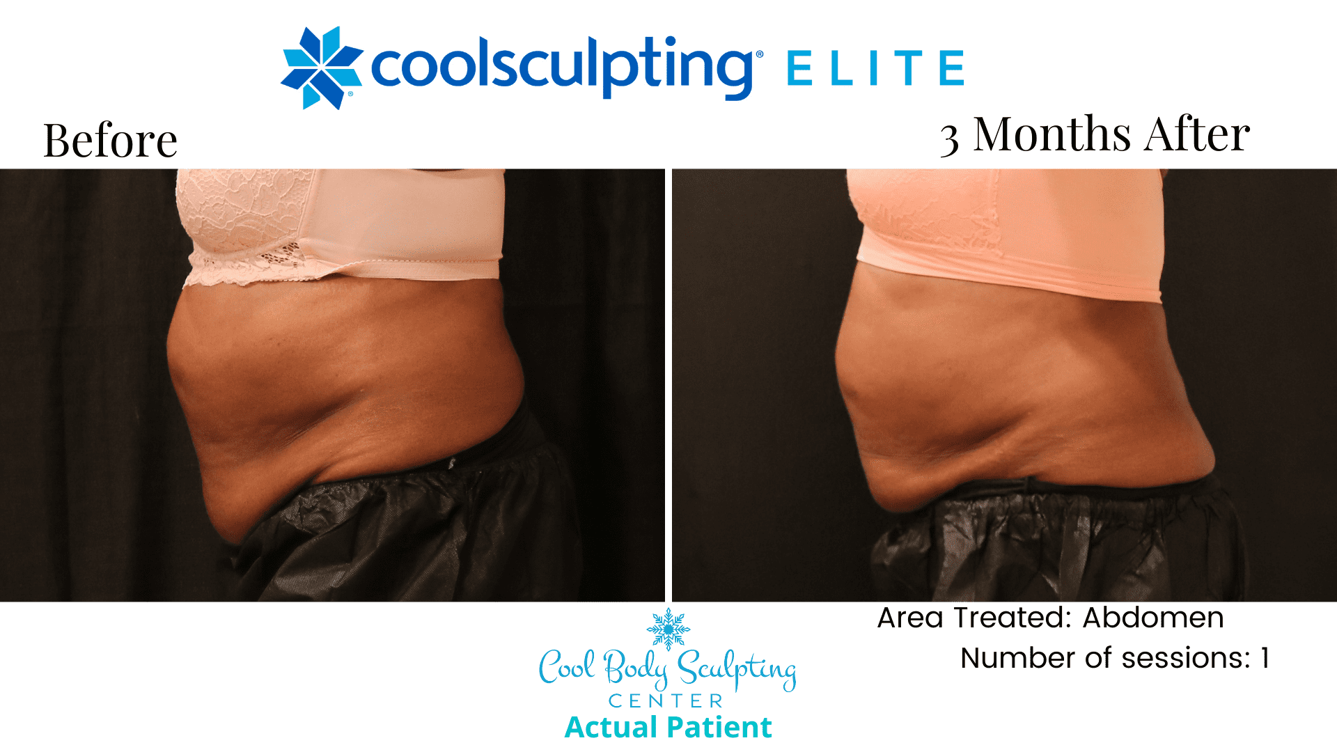 CoolSculpting Results | Cool Sculpting Before & After | Virginia Beach VA