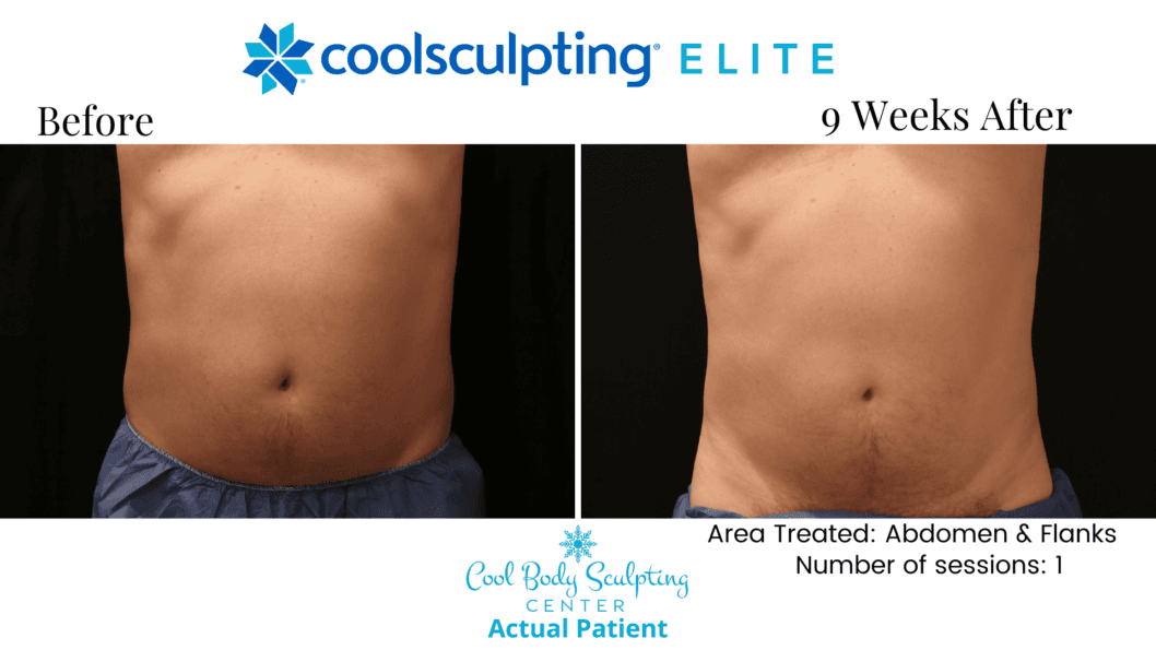 CoolSculpting Results - Cool Body Sculpting Center | Virginia Beach, VA