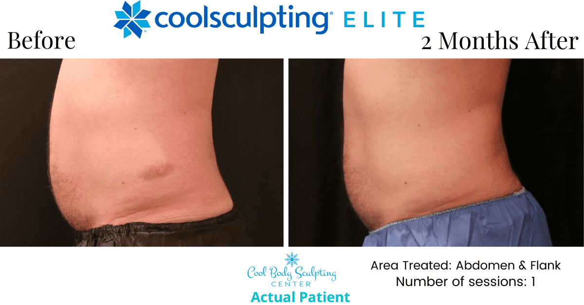 Cool Body Sculpting Center-CoolSculpting Price